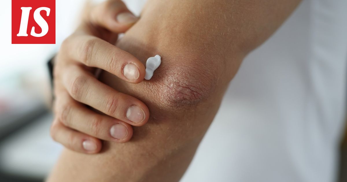 Mistä punoittava läiskä iholla voi johtua? Lääkäri kertoo: ruusu ...