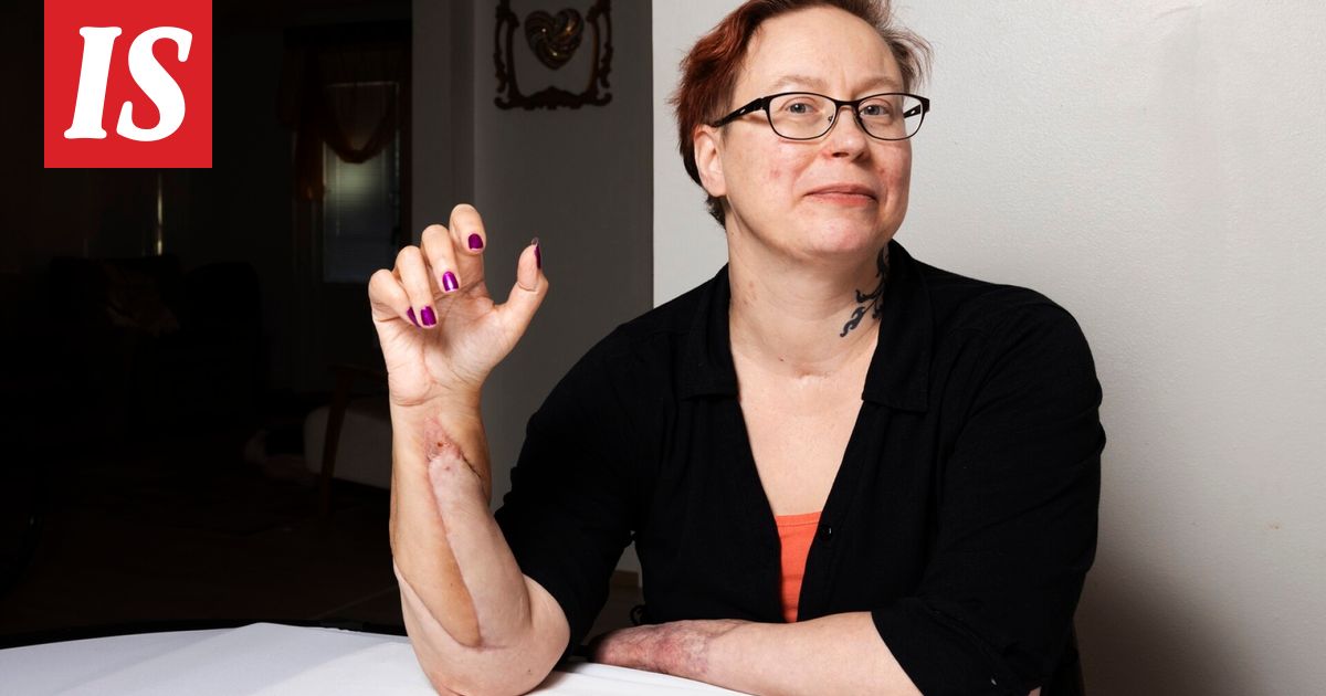 Ylen Käsi-dokumentti koskettaa: neliraaja-amputoitu Arja Ahtaanluoma ...