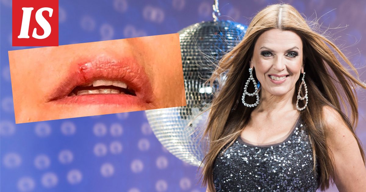 Eini loukkaantui keikallaan – julkaisi kuvan ruhjeista: ”Säikähdin menikö hampaat” - Ilta-Sanomat