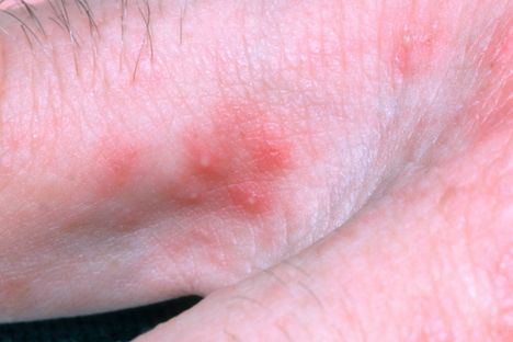 Syyhy on yleistynyt hurjasti – näin se tarttuu, tunnista oireet - Ilta-Sanomat