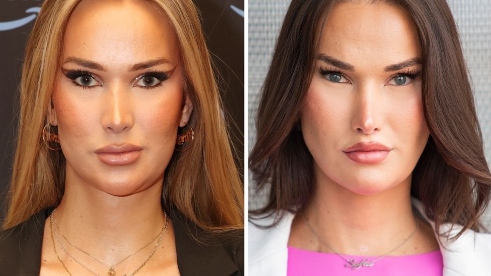 Tältä Sofia Tuomola näyttää kauneusleikkauksien jälkeen - Ilta-Sanomat