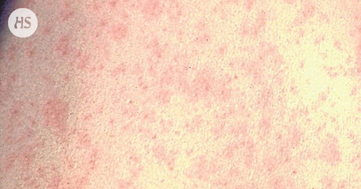 Tuhkarokko altistaa muille taudeille | HS.fi