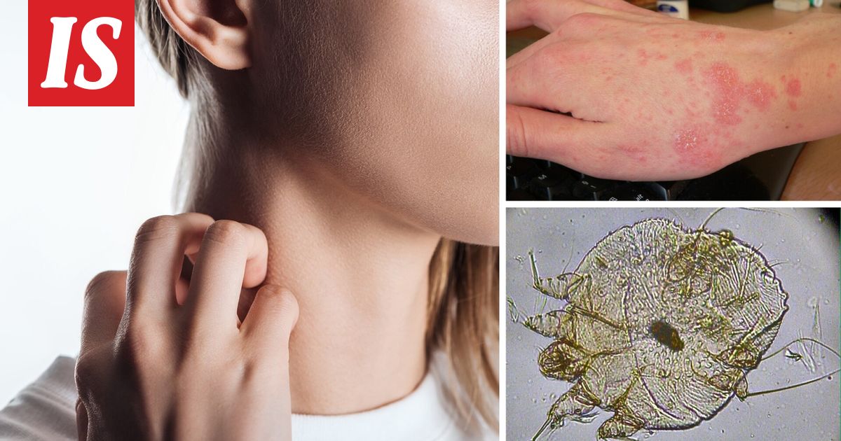 Jarmo maksoi syyhyn hoidosta 700 euroa – näin viheliäinen punkki voi ...