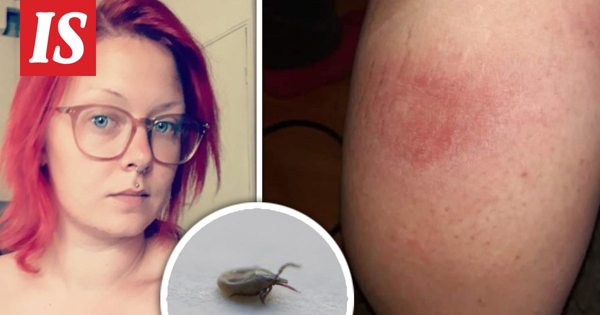 Tämä jälki pohkeessa paljasti borrelioosin – punkin purema vei Jennin ...