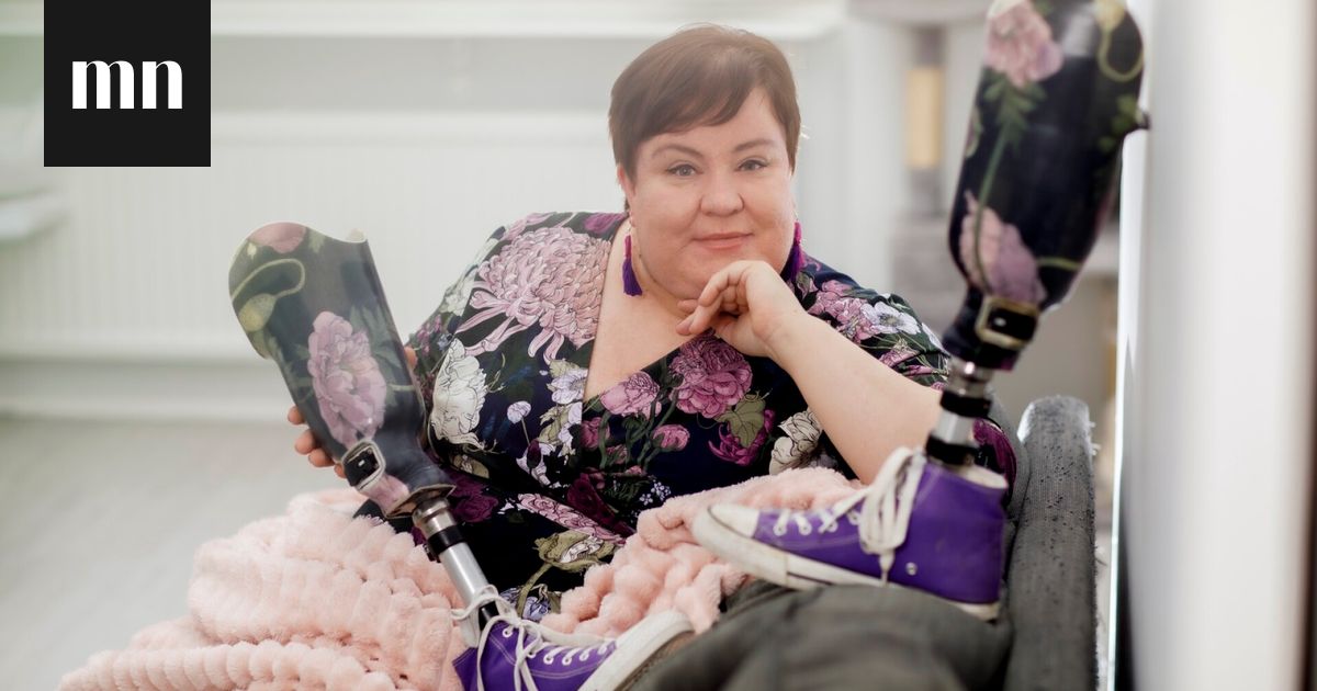 Jalkojen amputointi: Tällaista on, kun molemmat jalat on amputoitu ...