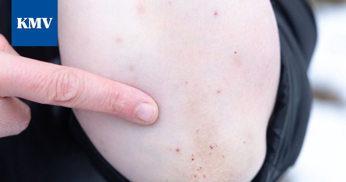 Mänttä-Vilppulassa on tavattu kaksi syyhytapausta – ”syyhy ei ole leviämässä, mutta seuraamme ...