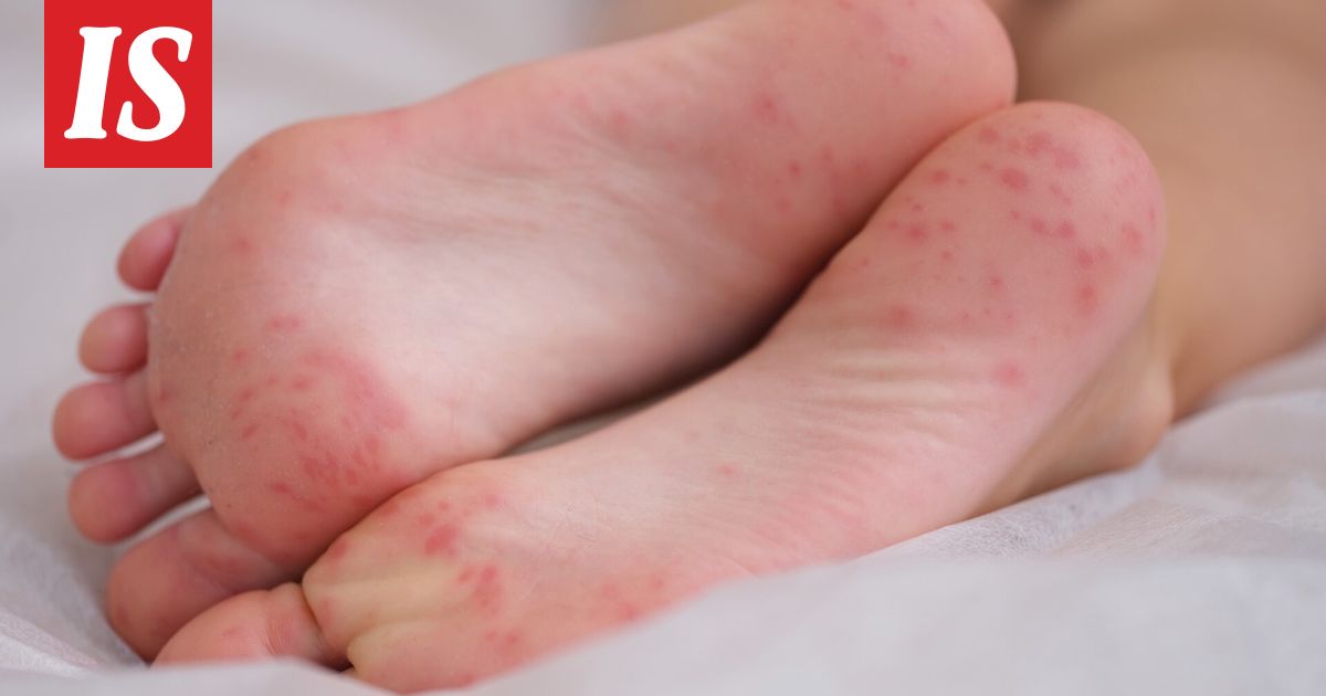 Miten lievittää enterorokon oireita? Lääkäri kertoo vinkkinsä ...