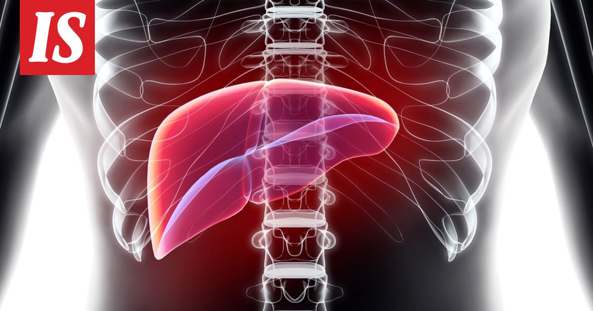 Maksasairaudet kovassa kasvussa – tunnista maksataudin oireet - Ilta ...
