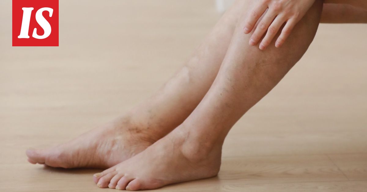 Veritulppa: Riskiä nostaa myös flunssakauden vuodelepo – tunnista ...